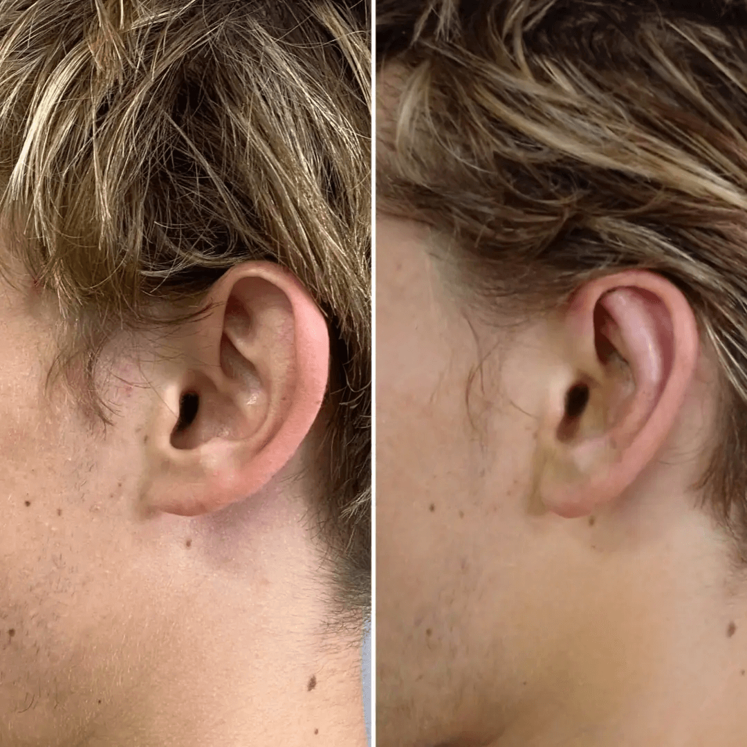 Otoplasty for Men in Tijuana, Mexico | Ear Pining