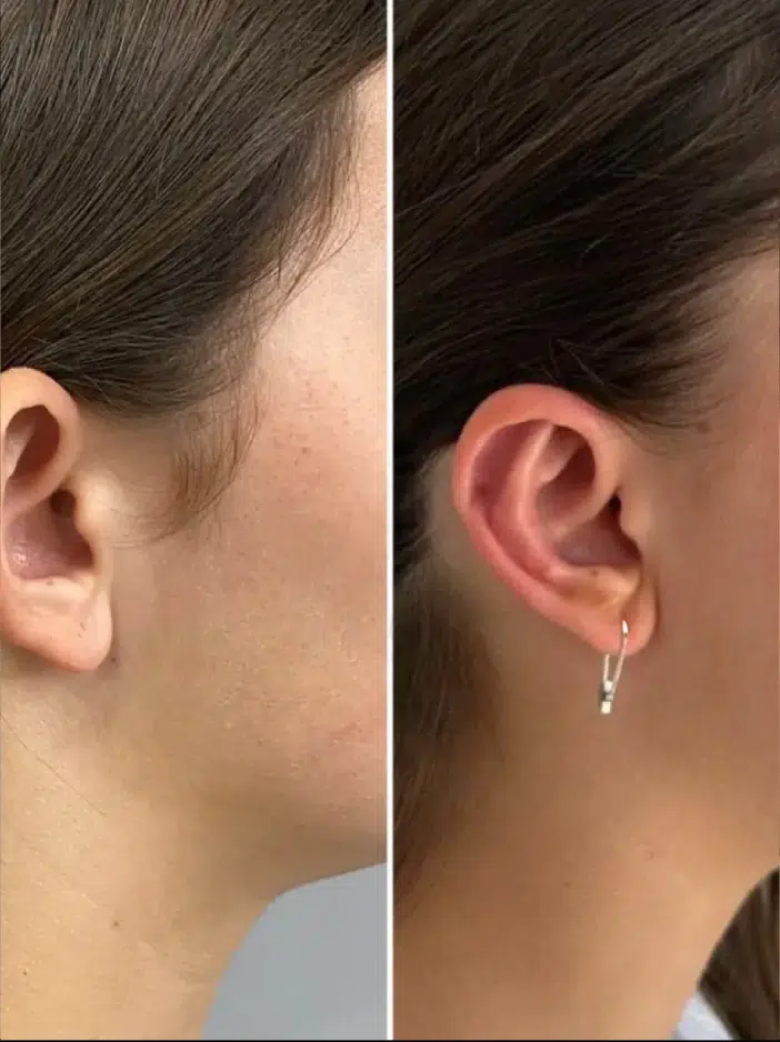 Otoplasty in Tijuana, Mexico | Ear Surgery in Mexico